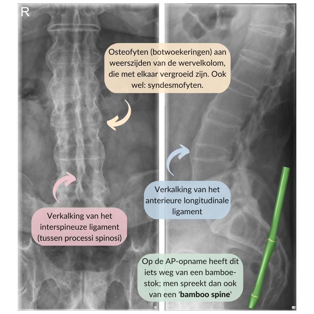 35-jarige man met progressieve rugpijn en stijfheid | Geneesleer
