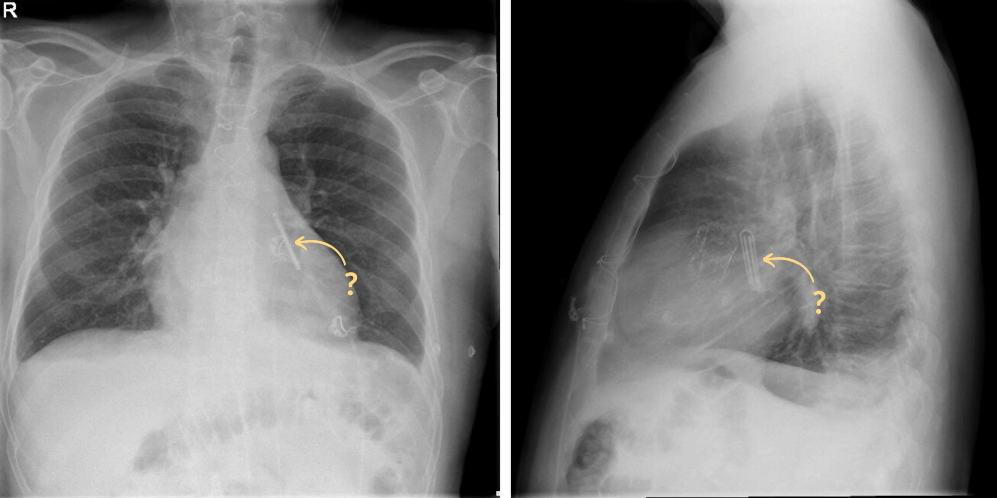 Casus: X-thorax met een device op het hart. | Geneesleer
