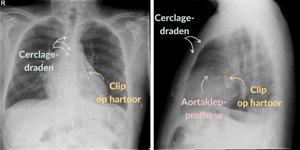 Casus: X-thorax met een device op het hart. | Geneesleer