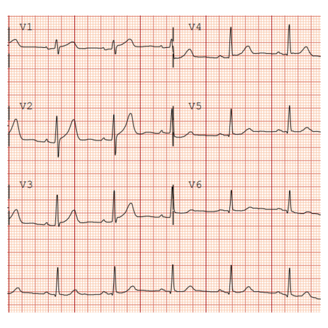 Wat valt je op aan dit ECG? | Geneesleer