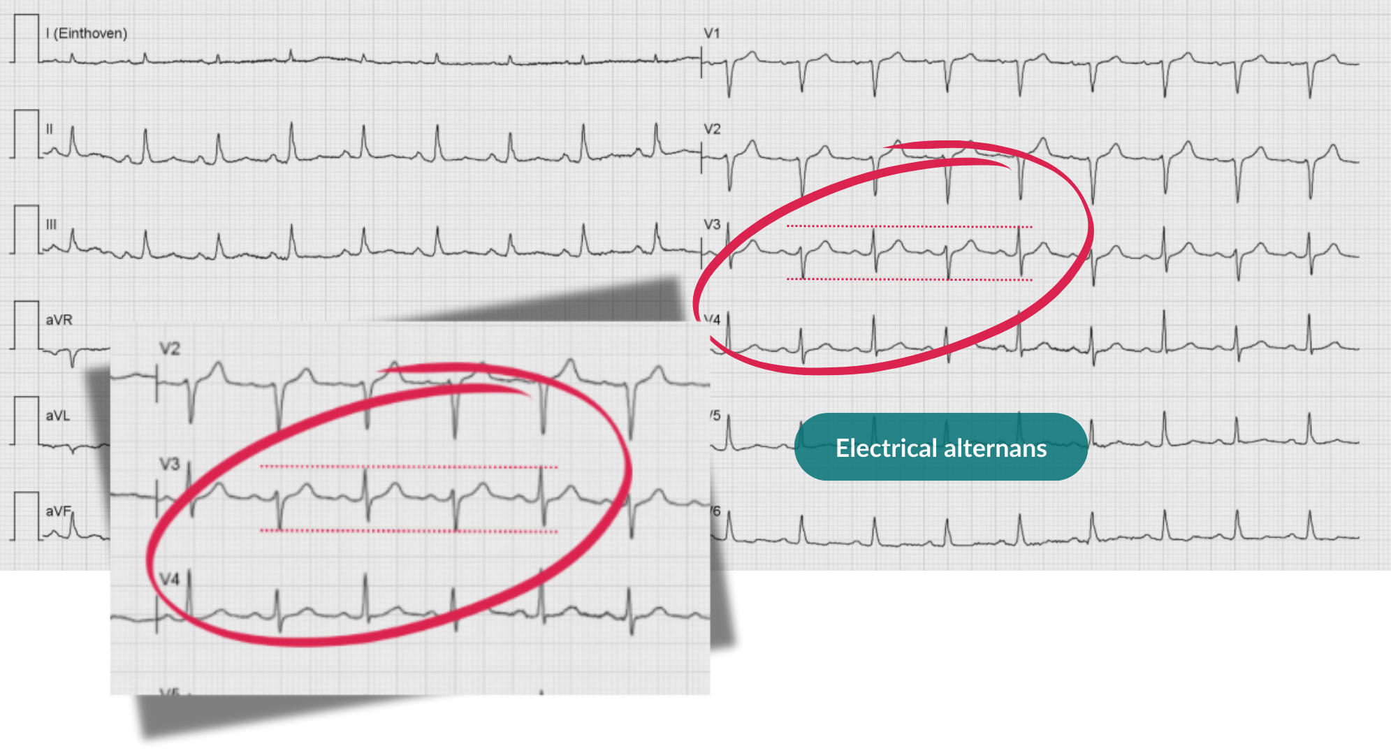 ECG-reeks | Geneesleer